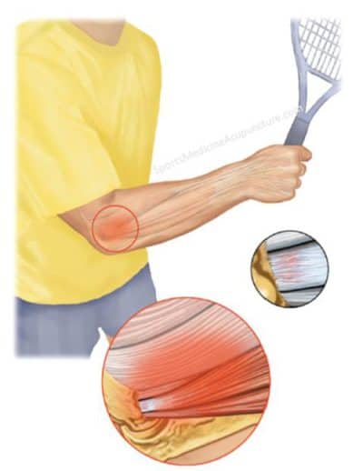Tennis Elbow: Extensor Carpi Radialis Brevis | AcuSport Education