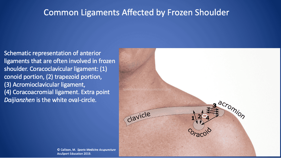 Adhesive Capsulitis (Frozen Shoulder): Stage One